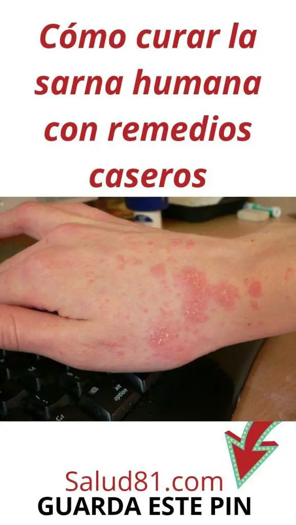 La sarna en las verduras - Cómo tratar la enfermedad de la sarna en la huerta - Consejos para mi ...